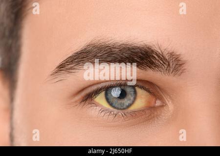 Sick man with yellow eyes. Liver disease. Problems with liver. Jaundice ...