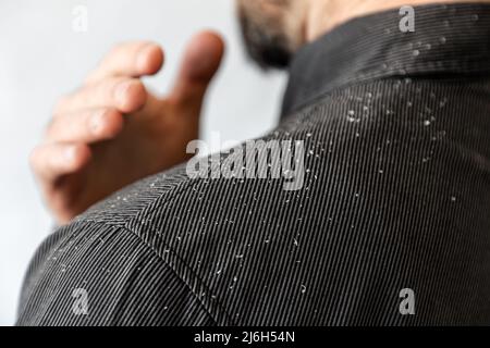 Man with seborrheic dermatitis in the beard area Stock Photo - Alamy