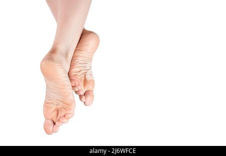 Dry and cracked soles of feet on white background, womans feet with dry ...