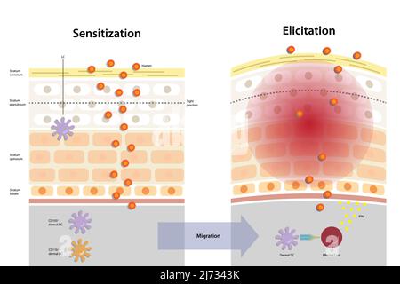 vector illustration of contact dermatitis. Allergy, dermatology Stock ...