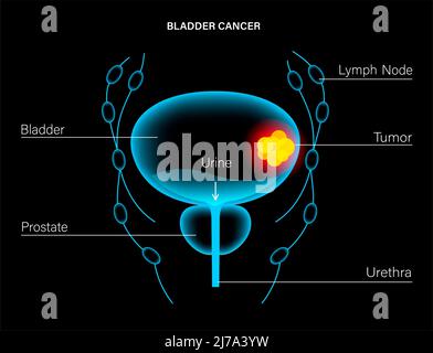 Bladder cancer stages, illustration Stock Photo - Alamy
