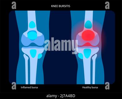 Knee bursitis, conceptual illustration Stock Photo - Alamy