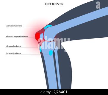 Knee bursitis, conceptual illustration Stock Photo - Alamy
