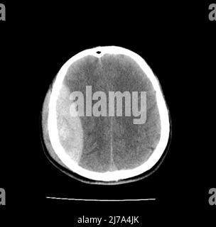 Traumatic brain injuries, CT scan Stock Photo - Alamy