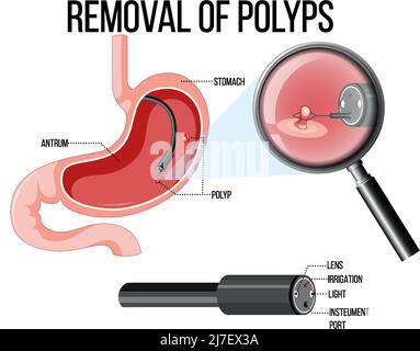 Diagram showing removal of polyps illustration Stock Vector Image & Art ...