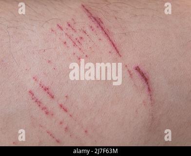 Scratch, abrasion, cut on the skin. wound Stock Photo - Alamy
