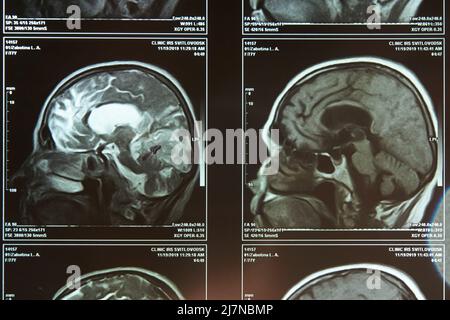 A fragment of an image of an elderly person's brain scan on magnetic ...
