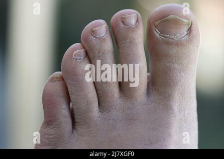 Toes with little toes bent, and toes that are not maintained Stock ...