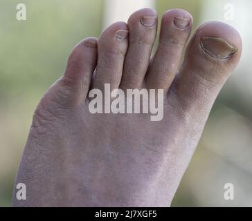 Human skin disease. Person s foot that is affected by dermatological ...