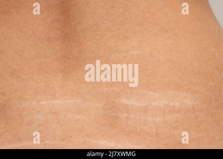 Stretch marks on the lower back Stock Photo - Alamy