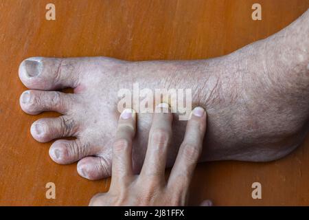 Pitting edema of lower limb. Swollen leg of Asian old man Stock Photo ...