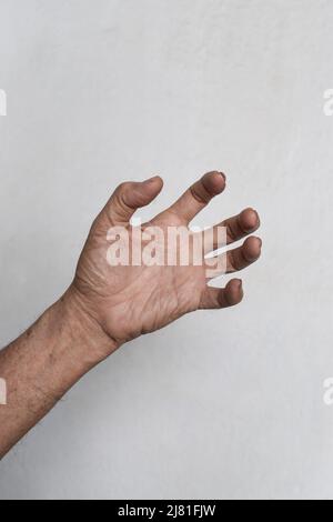 Volkmann’s contracture in upper limb of Asian young man. It is a ...