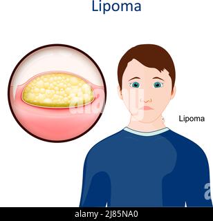 vector illustration of a lipoma Stock Vector Image & Art - Alamy