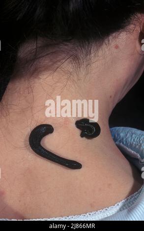 The medicinal leech Hirudo medicinalis sucking blood from a human arm ...