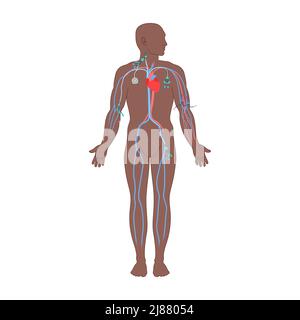 Femoral central venous catheter, illustration Stock Photo - Alamy