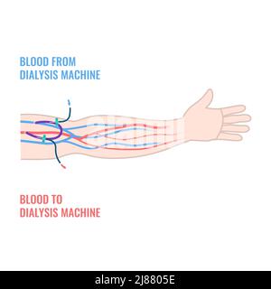 Dialysis shunt graft catheter, illustration Stock Photo - Alamy