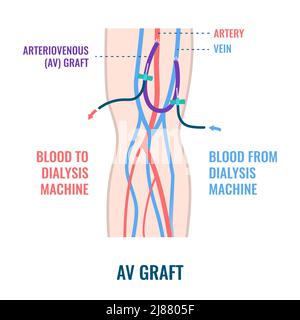 Dialysis shunt graft catheter, illustration Stock Photo - Alamy