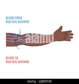 Dialysis shunt graft catheter, illustration Stock Photo - Alamy