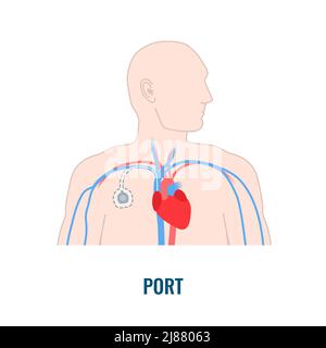 Venous access port, illustration Stock Photo - Alamy