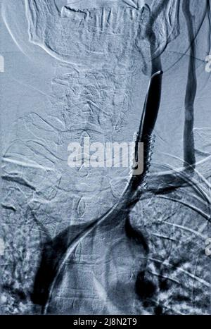 Coronary stent, X-ray Stock Photo - Alamy