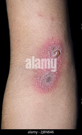 Paederus dermatitis in arm. It is a peculiar, irritant contact one ...