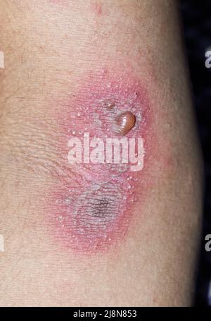 Paederus dermatitis in arm. It is a peculiar, irritant contact one ...