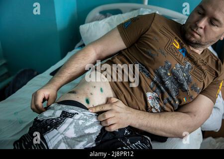Soldier Sergei (38) shows his injuries as he suffered multiple bone ...
