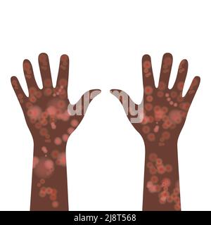 Rash on hand and arm skin, isolated medical icon Stock Vector Image ...
