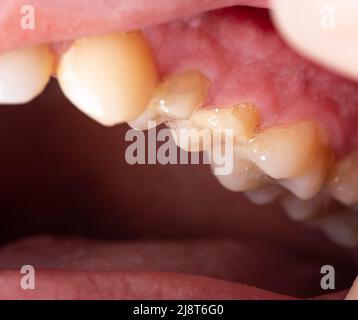 Dissection of decayed teeth for the installation of a dental crown in ...