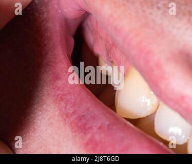 Dissection of decayed teeth for the installation of a dental crown in ...