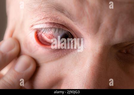 Subconjunctival hemorrhage - hyposphagma. Closeup of red bloodshot eye ...