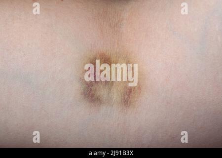 Vein hematoma after blood sampling Stock Photo - Alamy