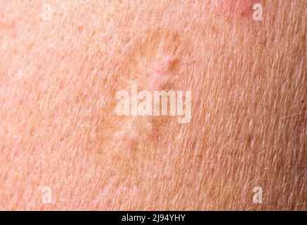 A scar from a smallpox vaccination is visible on an mature woman upper ...