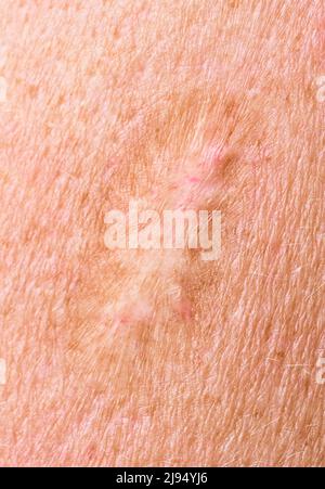 A scar from a smallpox vaccination is visible on an mature woman upper ...