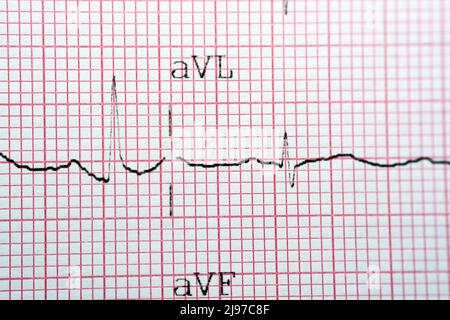 Normal electrocardiogram (ECG) pattern Stock Photo - Alamy