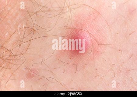 Large acne spot or pimple on a mans neck Stock Photo - Alamy