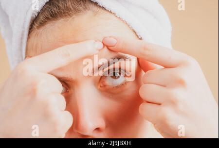 Close up squeezing pimples on her face. Acne blemish spots skin on ...