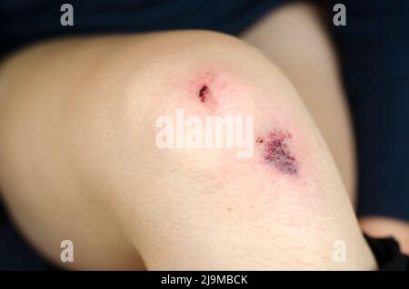 Small wound on human knee macro close up view Stock Photo - Alamy