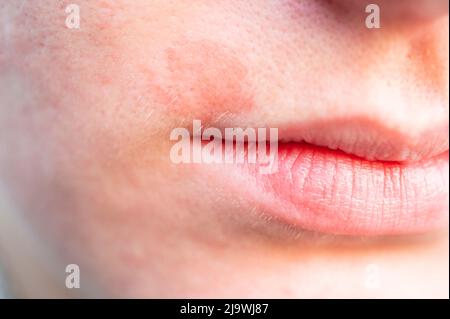 Female with skin rash on face Stock Photo - Alamy