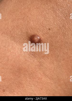 abscess or skin disease on human thigh is isolated on white background ...