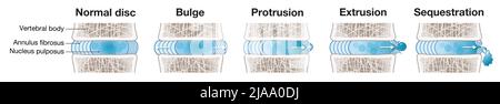Illustration showing normal lumbar disc and disc protrusion and disc ...