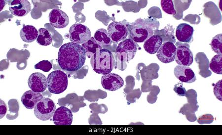 Photomicrograph of human white blood cells with acute myelocytic ...