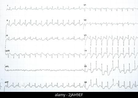 A positive stress induced myocardial ischemia with significant ...