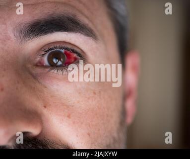 Subconjunctival hemorrhage on man eye. Bloody eye. Broken blood vessel ...