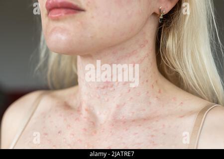 Papules after beauty injections on the face. Closeup photo Stock Photo ...