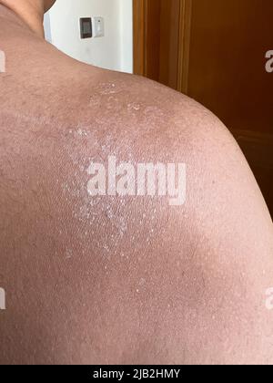 Peeling skin after sunburn, dermatology problems at woman hand and ...