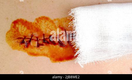 Medical sutures, stitch after surgery, stitched surgical sutures on ...