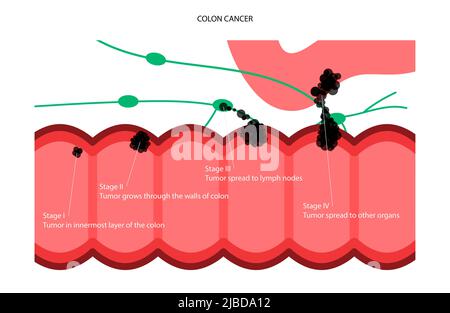 Illustration of the stages of colorectal cancer tumour development ...