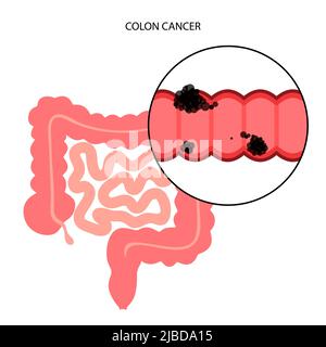 Illustration of the stages of colorectal cancer tumour development ...