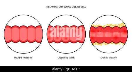 Ulcerative colitis as an inflammatory intestine with healthy and ...